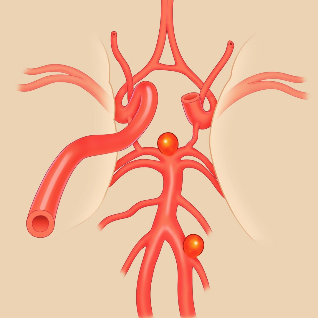 Aneurysm Detection